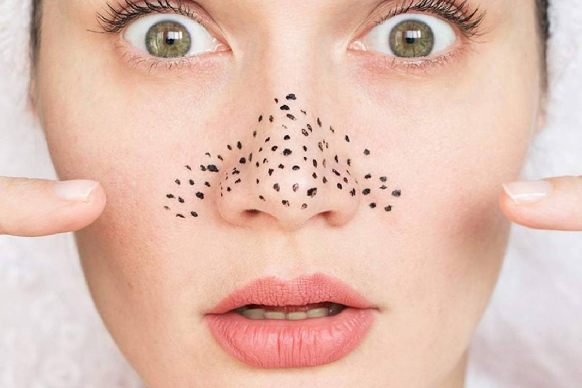 How to Remove Blackheads from Nose? – Definition, Causes,